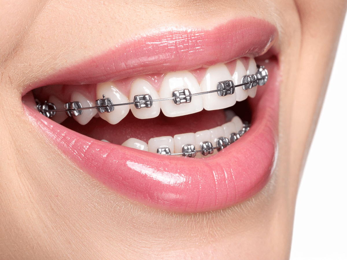 Metal Braces Cost for Kids, Teens & Adults | Elite Orthodontics
